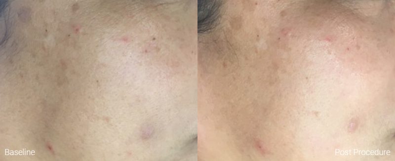 AQUAPURE ll | CLUEDERM B2B