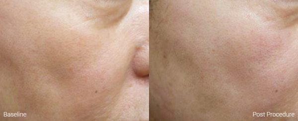 AQUAPURE | CLUEDERM B2B