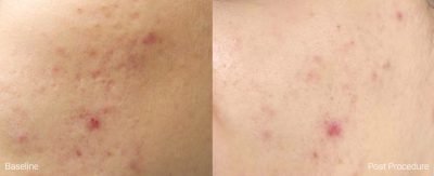 AQUAPURE | CLUEDERM B2B